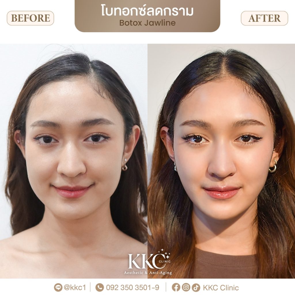 Before & After | KKC Clinic