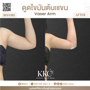 VASER Liposuction in Bangkok at KKC Clinic
