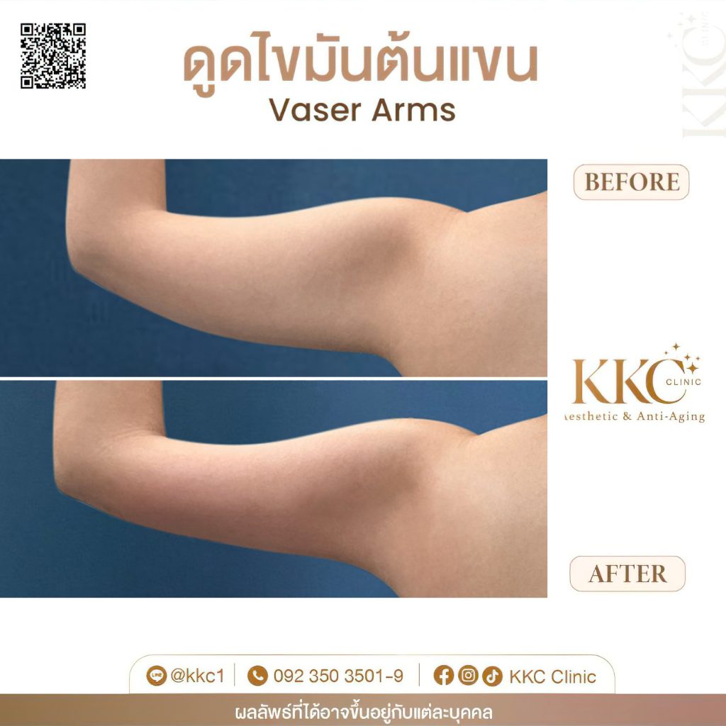 VASER Liposuction in Bangkok at KKC Clinic