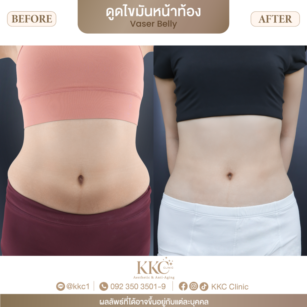 VASER Liposuction in Bangkok at KKC Clinic