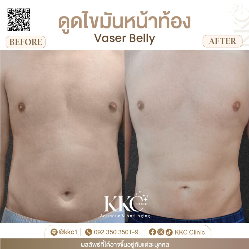 VASER Liposuction in Bangkok at KKC Clinic