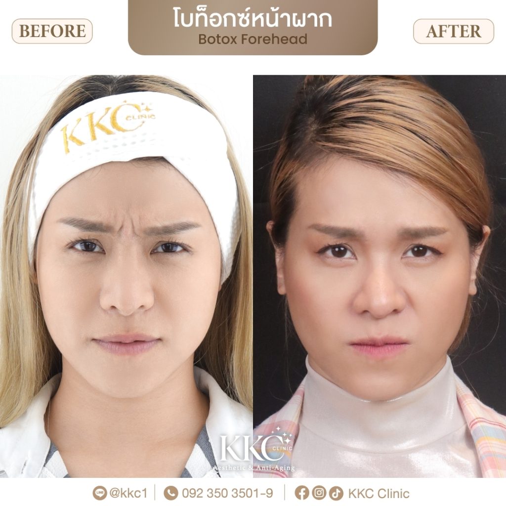 Before & After | KKC Clinic