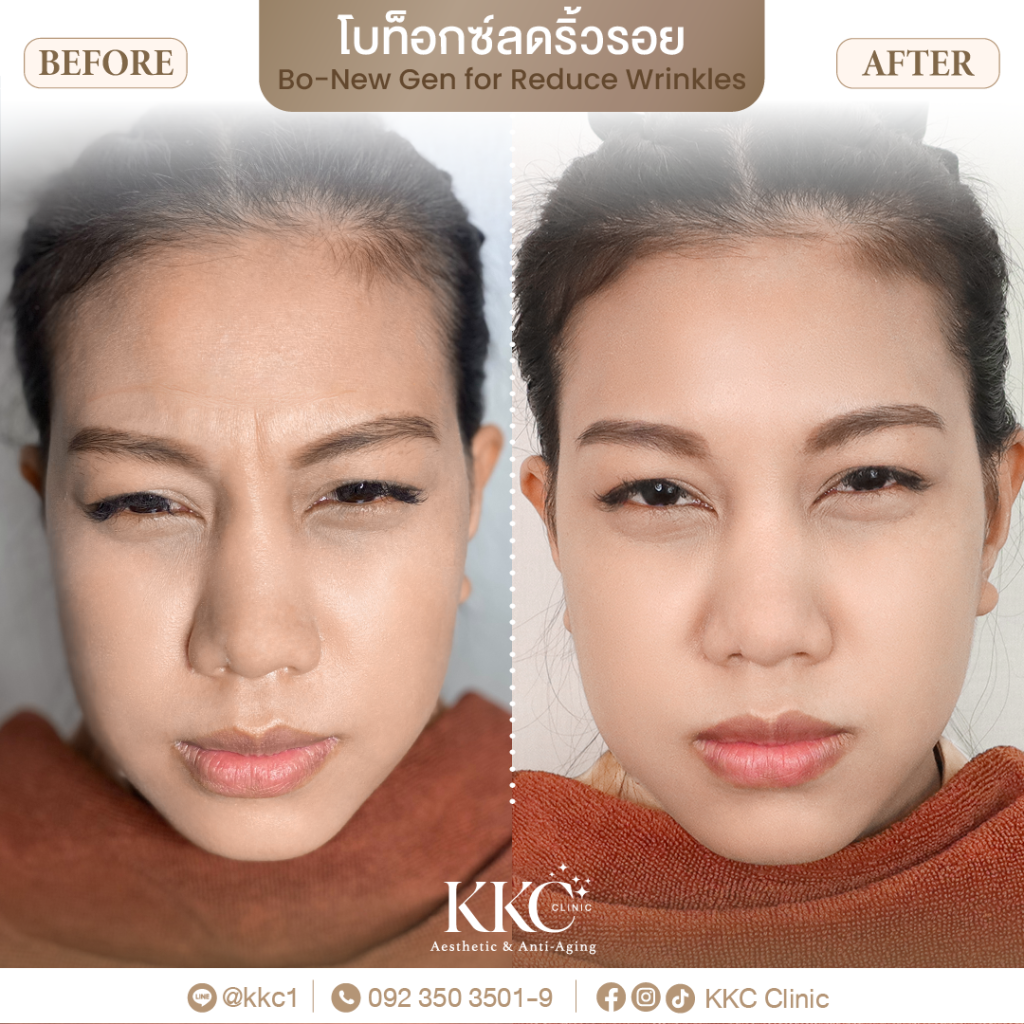 Before & After | KKC Clinic