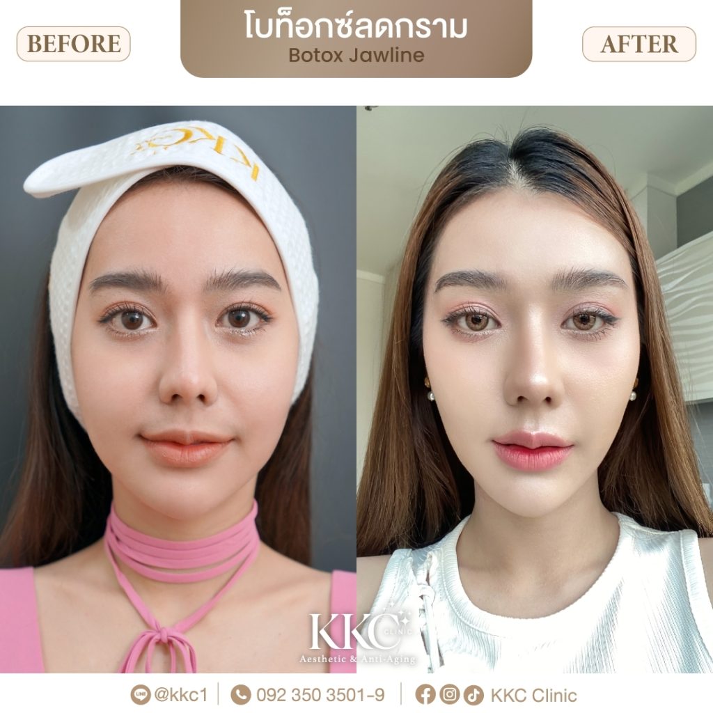 Before & After | KKC Clinic