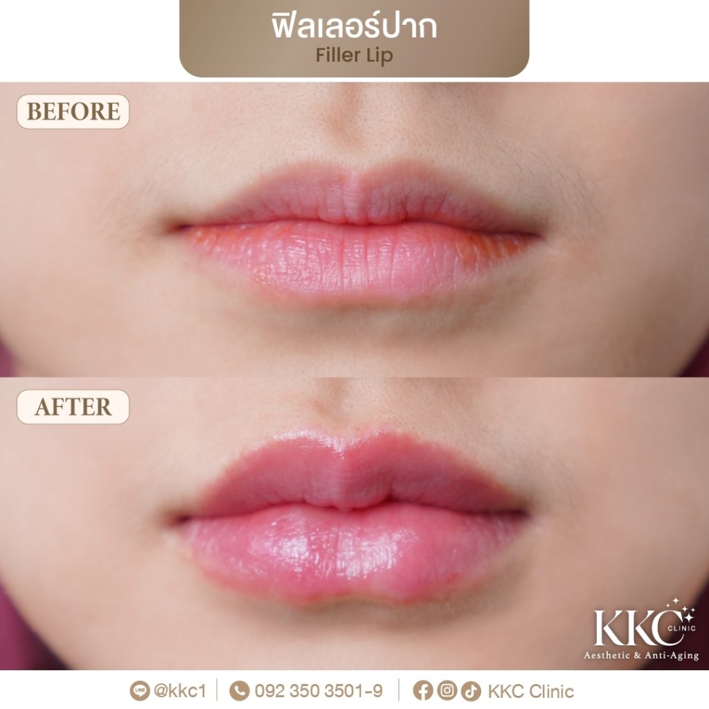 Lip Fillers in Bangkok at KKC Clinic