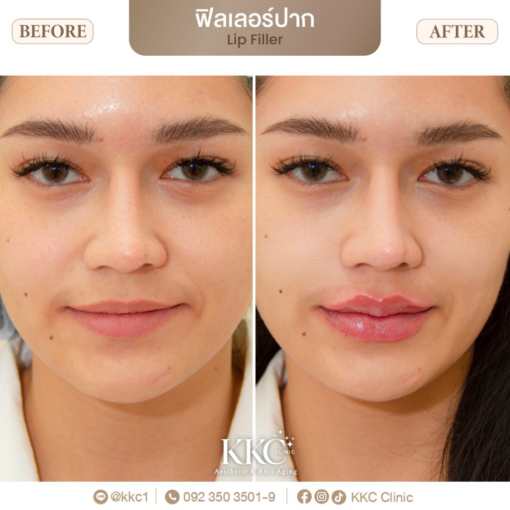 Lip Fillers in Bangkok at KKC Clinic