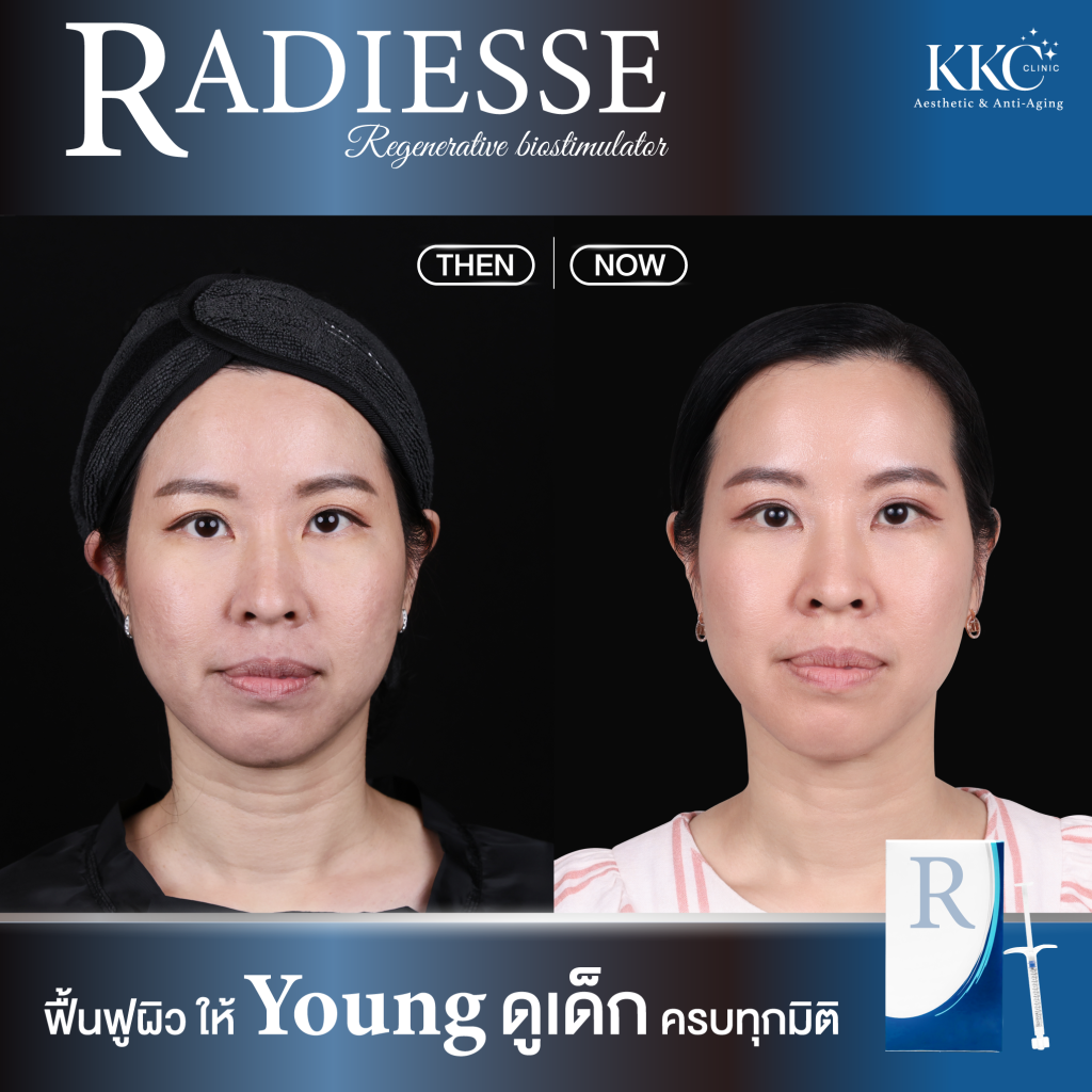 Radiesse in Bangkok: The Unique Regenerative Biostimulator | KKC Clinic