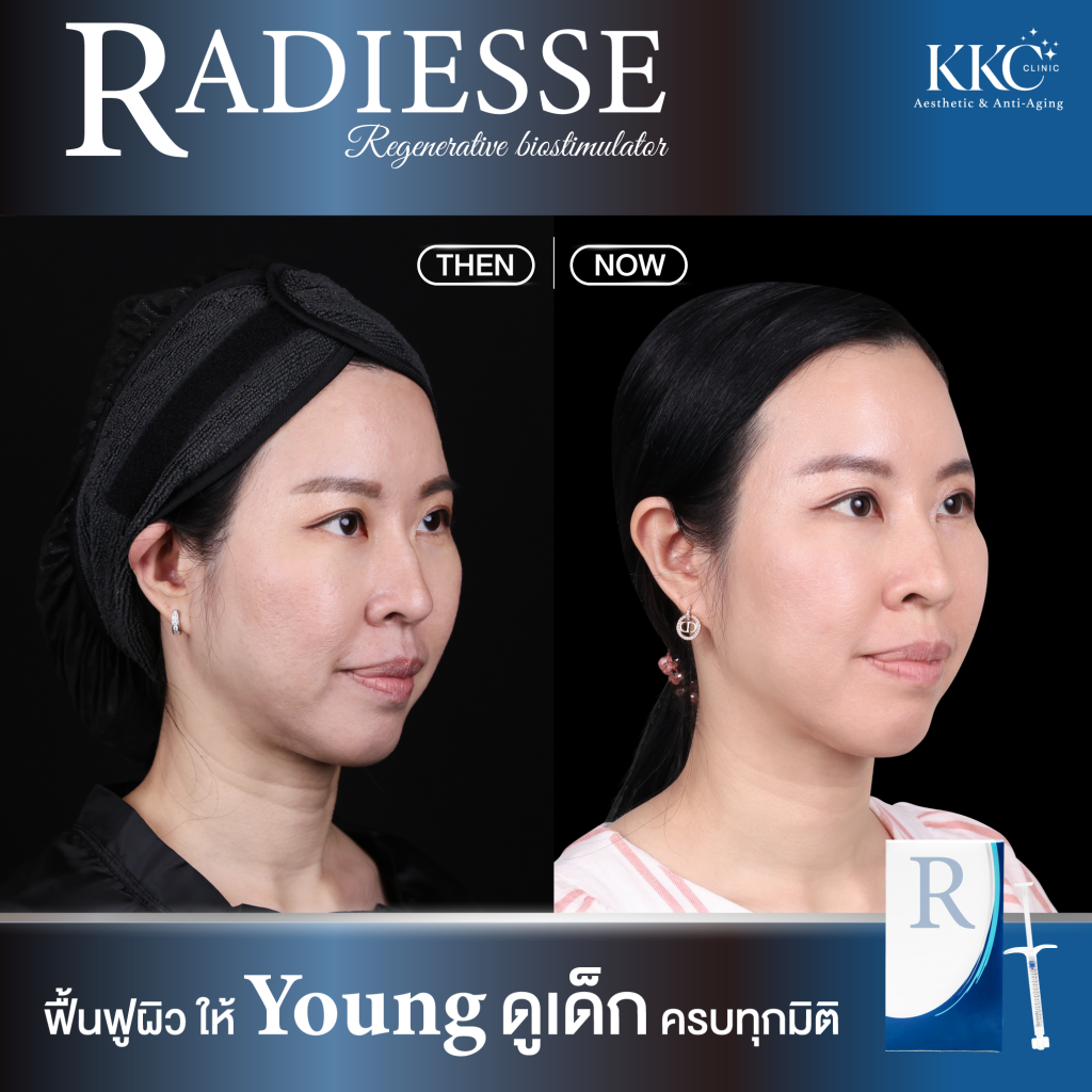 Radiesse in Bangkok: The Unique Regenerative Biostimulator | KKC Clinic
