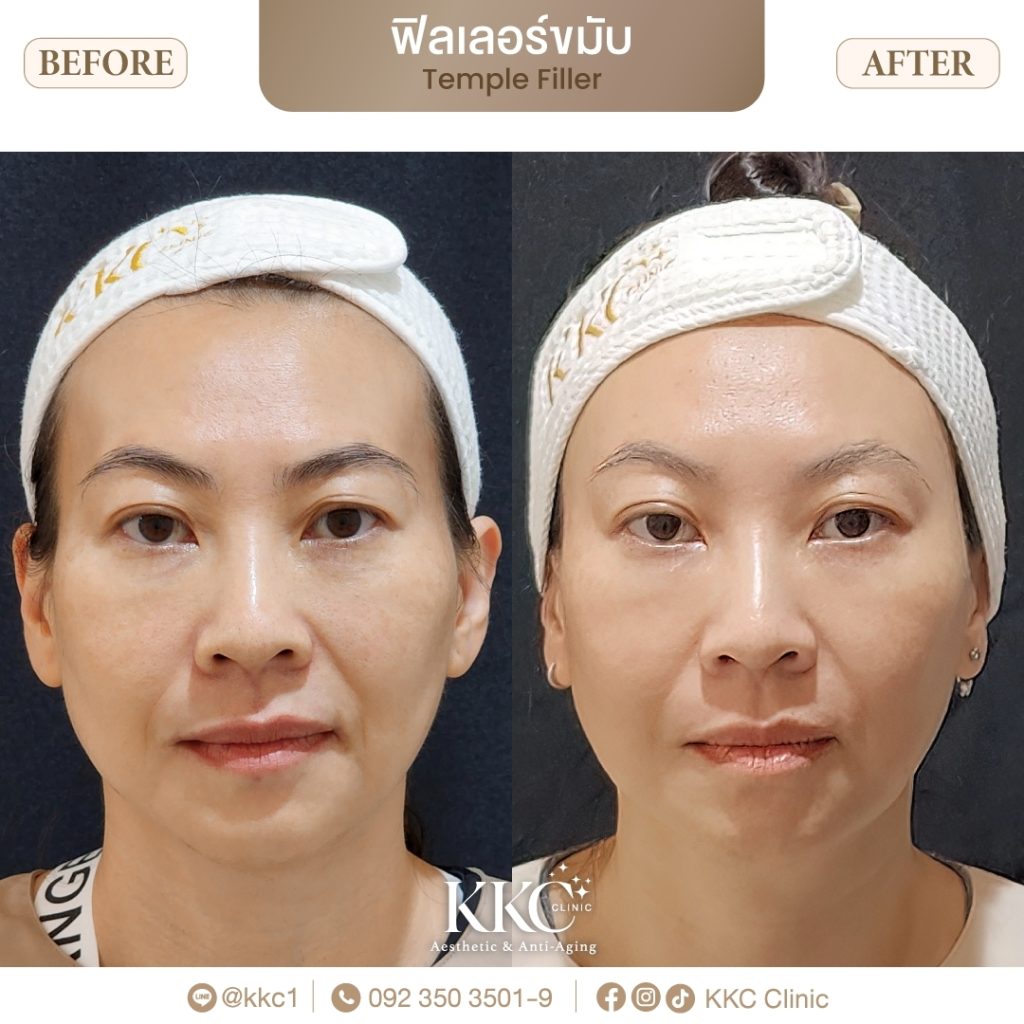 Before & After | KKC Clinic