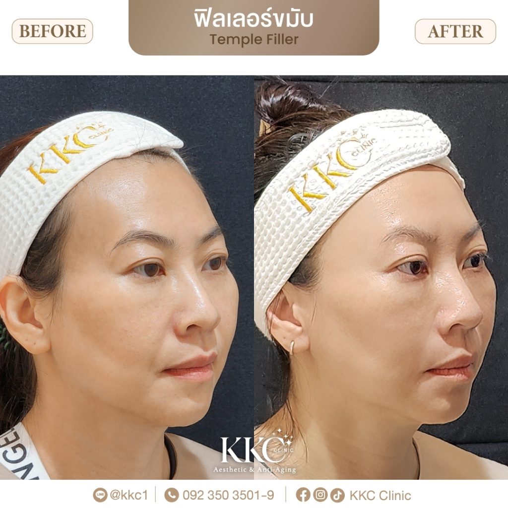 Before & After | KKC Clinic
