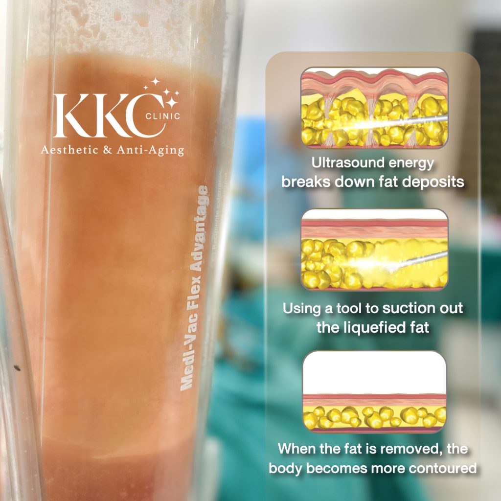 VASER Liposuction in Bangkok at KKC Clinic