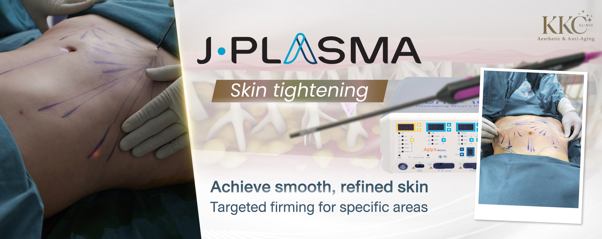 J-Plasma: Quick & Safe Skin Tightening with Minimal Downtime