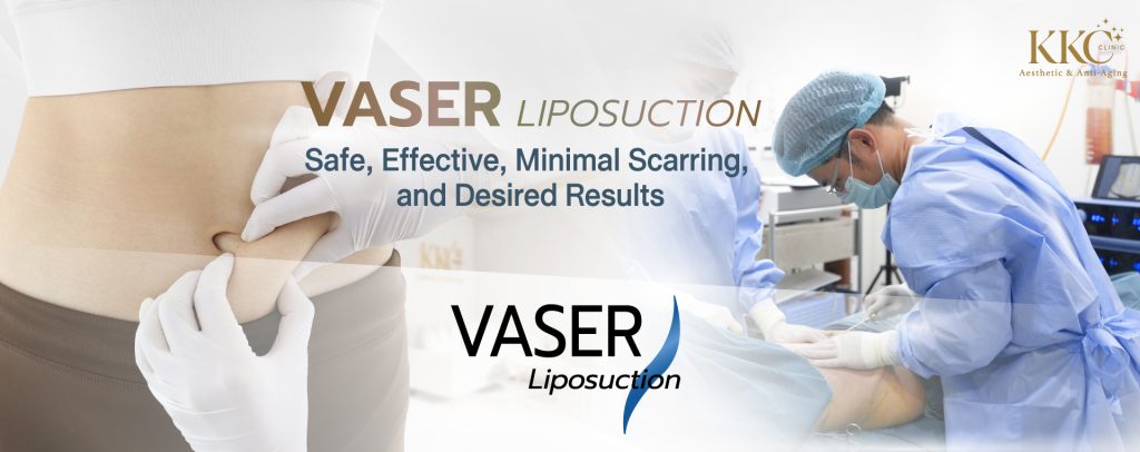 VASER Liposuction in Bangkok at KKC Clinic