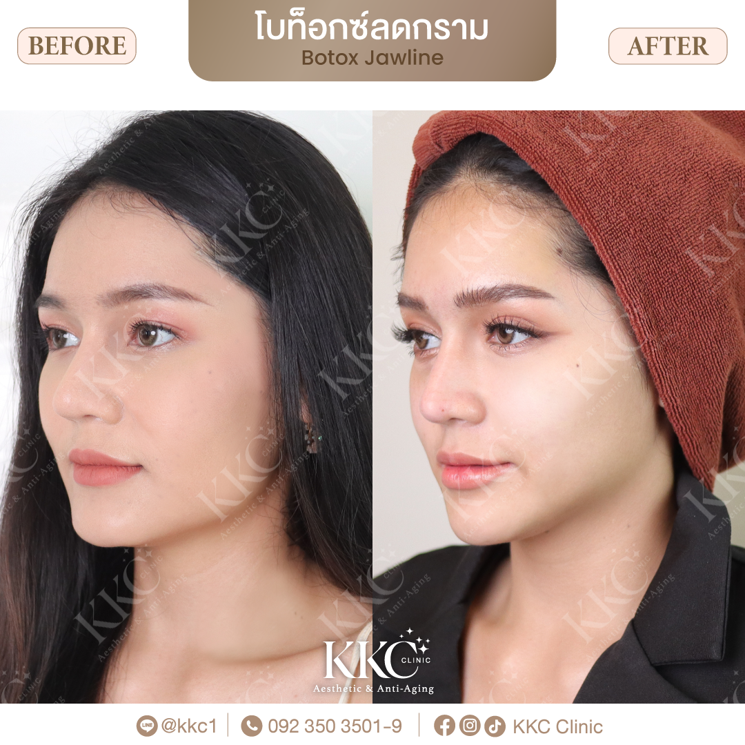Masseter Botox in Bangkok for Jawline Slimming | KKC Clinic