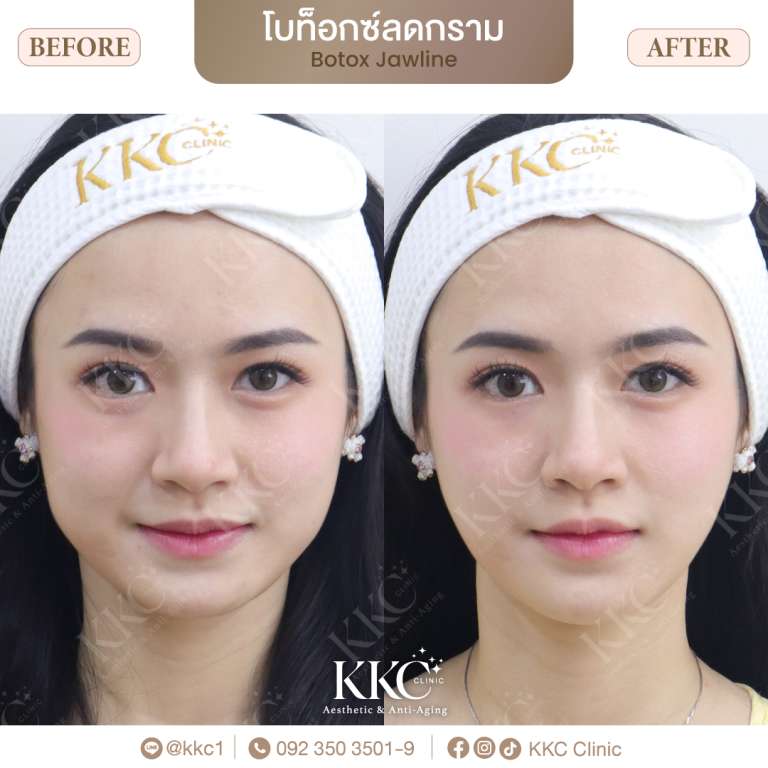 Masseter Botox in Bangkok for Jawline Slimming | KKC Clinic