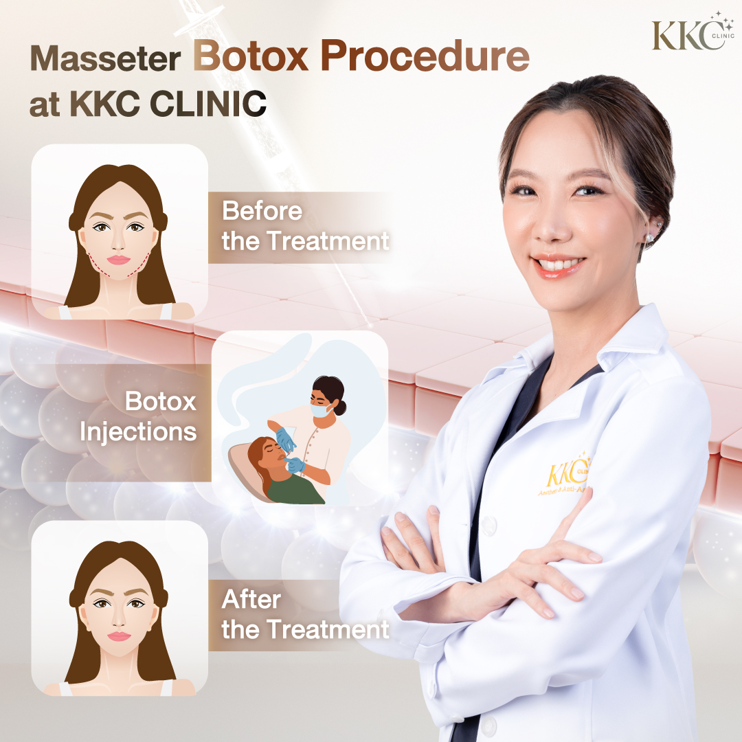 Masseter Botox in Bangkok | KKC Clinic