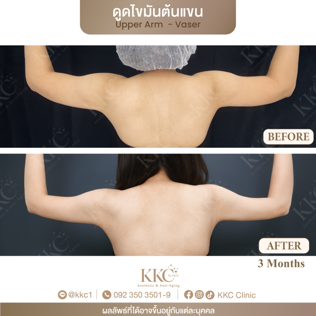 Arm Liposuction in Bangkok: Sculpt & Tone Your Arms | KKC Clinic