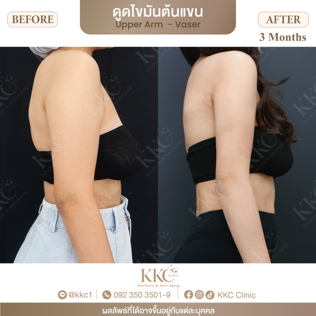 Arm Liposuction in Bangkok: Sculpt & Tone Your Arms | KKC Clinic