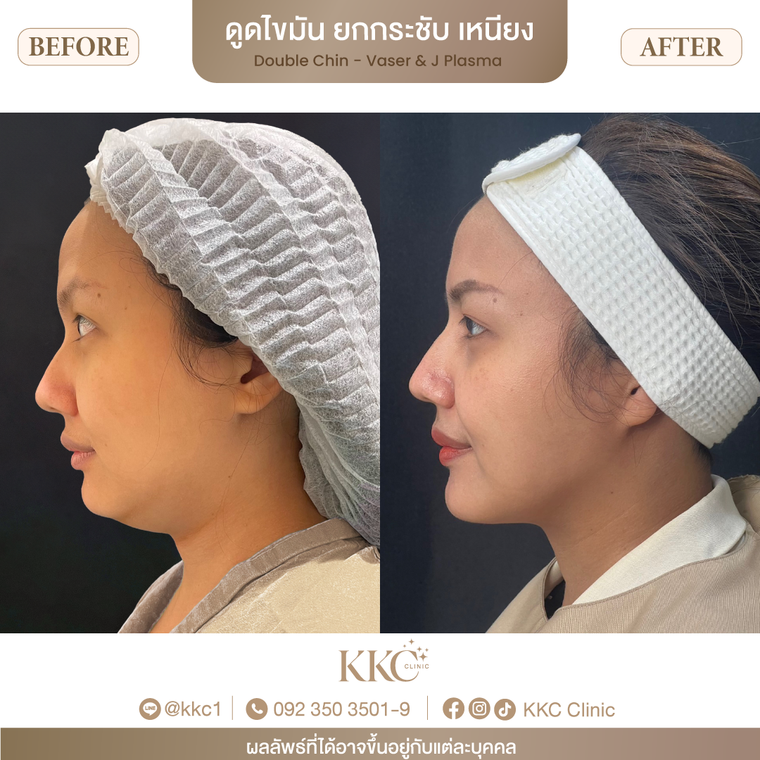 Achieve a Defined Jawline with Chin Liposuction | KKC Clinic