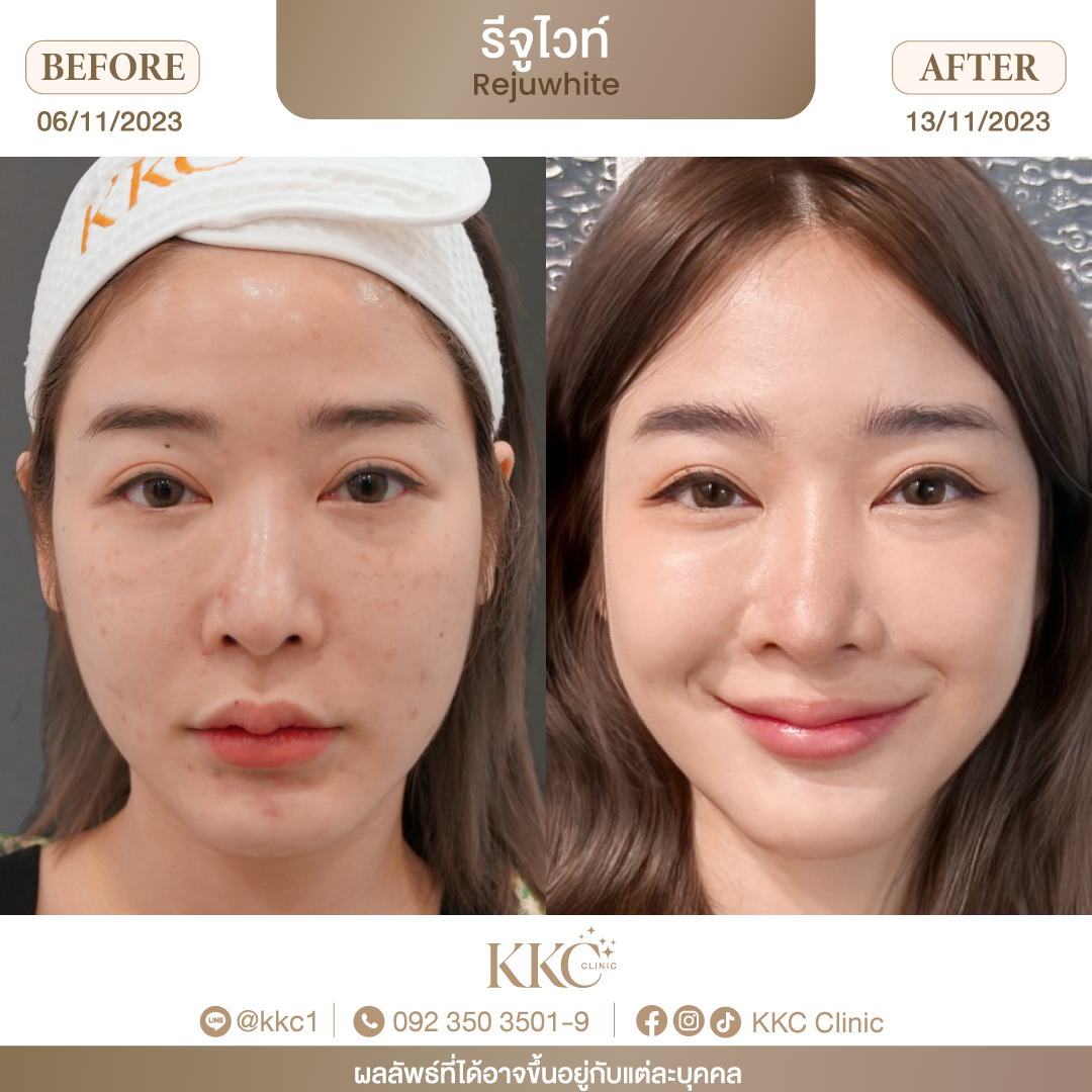 โปรแกรมการฉีดหน้าใส Rejuwhite เพื่อผิวดีที่ขาวกระจ่างใส | KKC Clinic