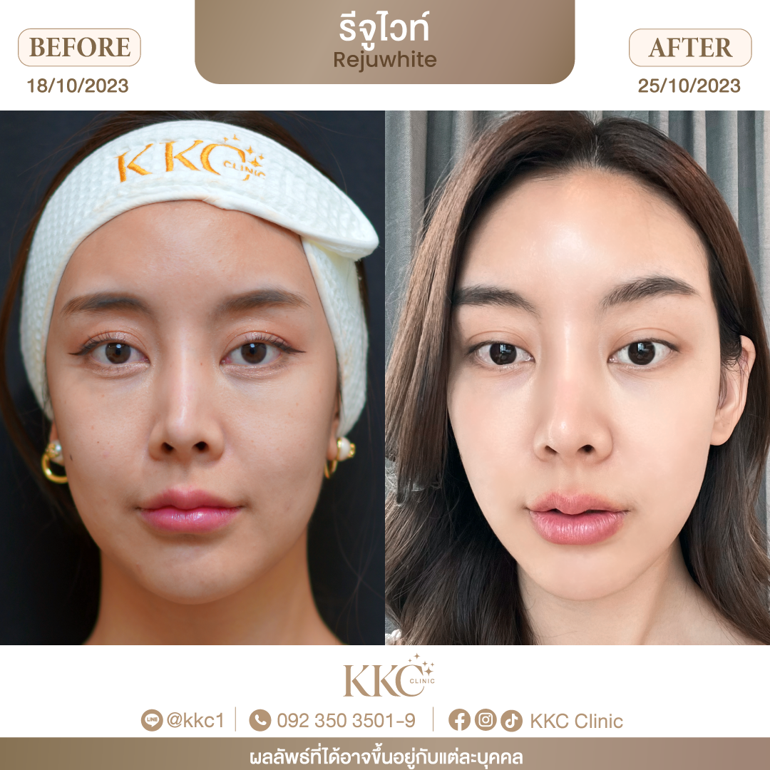 โปรแกรมการฉีดหน้าใส Rejuwhite เพื่อผิวดีที่ขาวกระจ่างใส | KKC Clinic