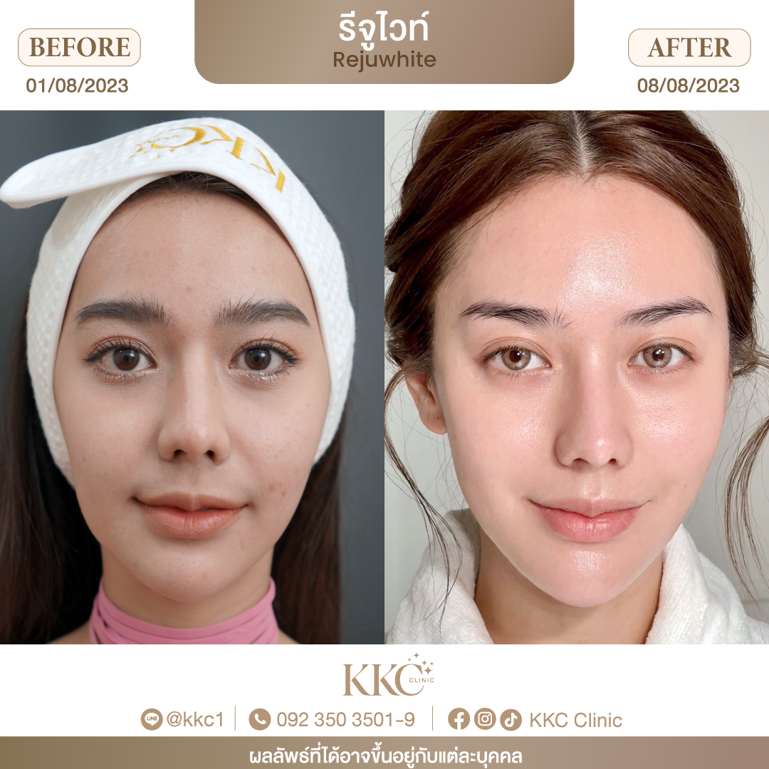 โปรแกรมการฉีดหน้าใส Rejuwhite เพื่อผิวดีที่ขาวกระจ่างใส | KKC Clinic