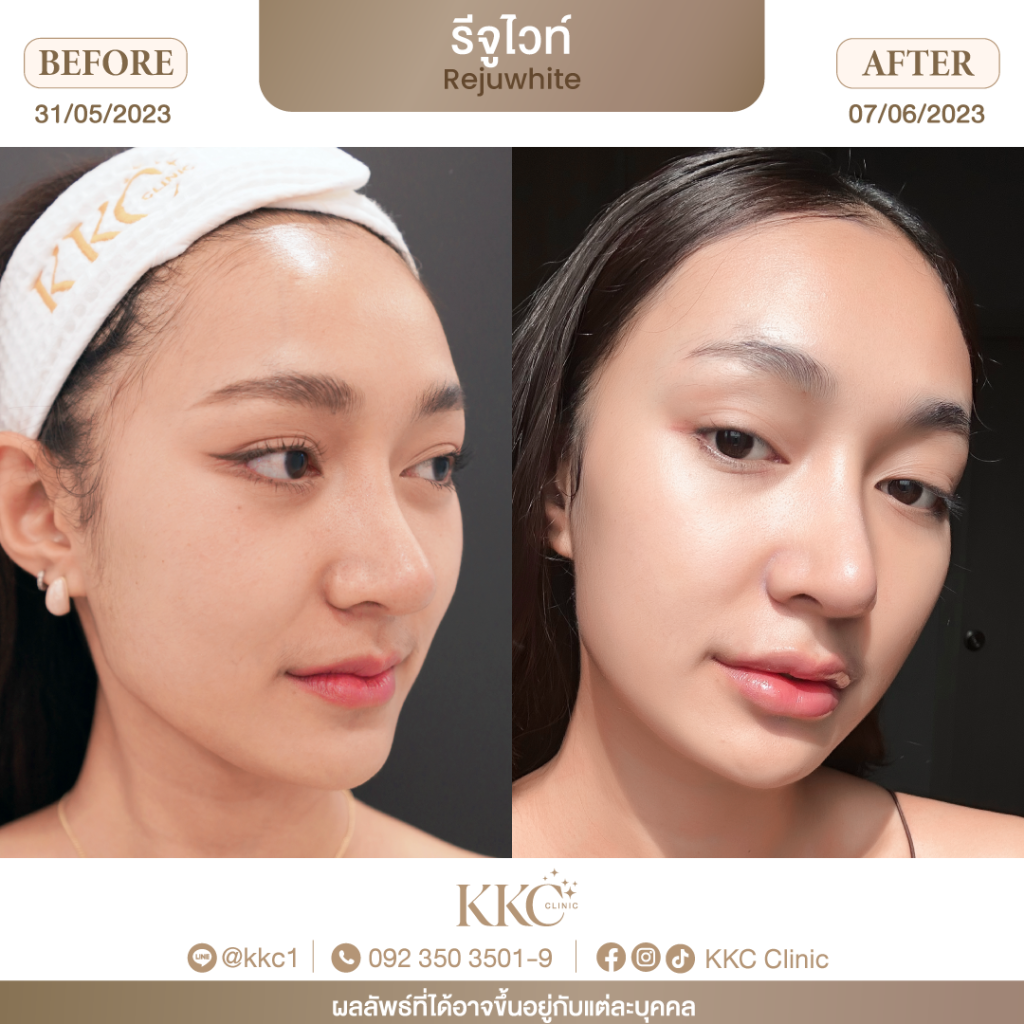 โปรแกรมการฉีดหน้าใส Rejuwhite เพื่อผิวดีที่ขาวกระจ่างใส | KKC Clinic