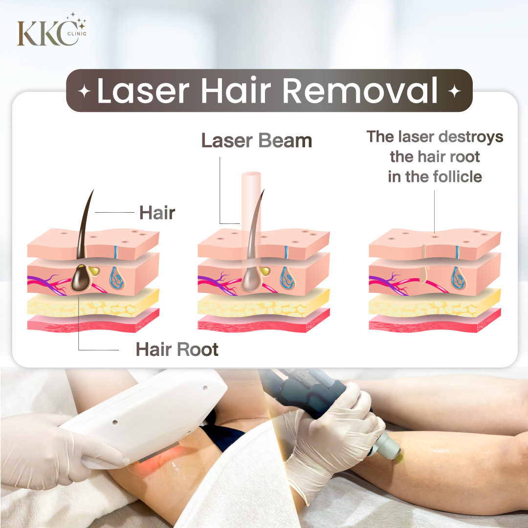 Laser Hair Removal in Bangkok | Smooth, Long-Lasting Results | KKC Clinic