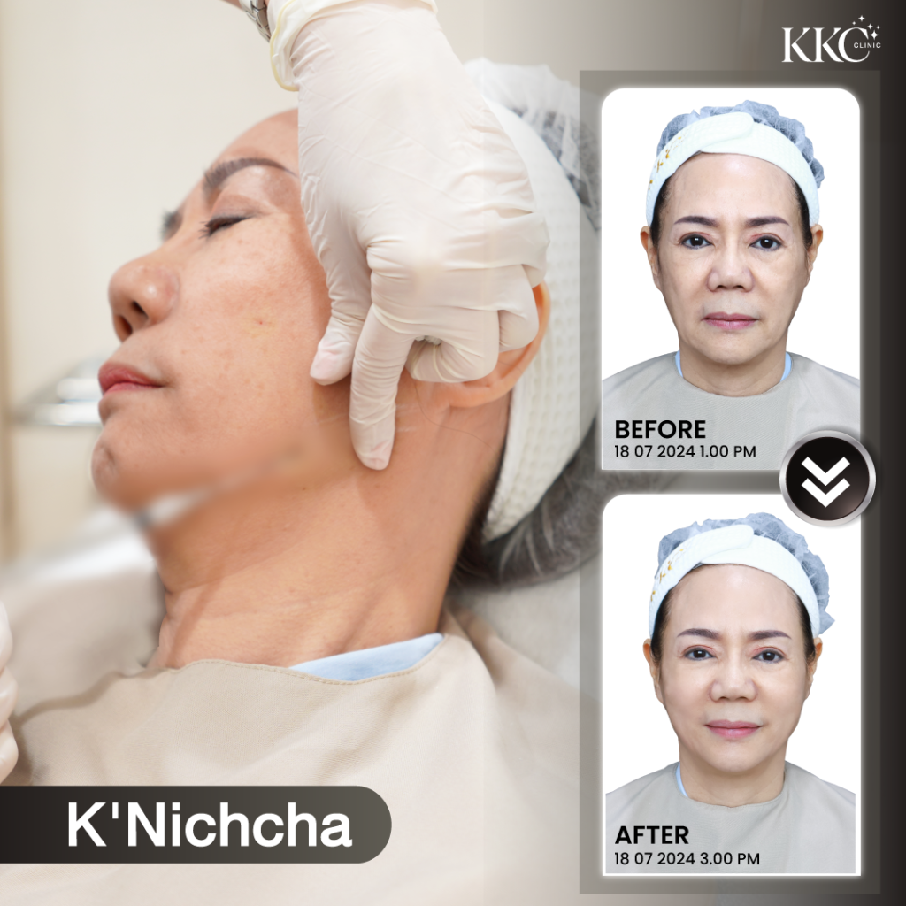 Asian MD Codes: Non-Surgical Face Contouring Bangkok