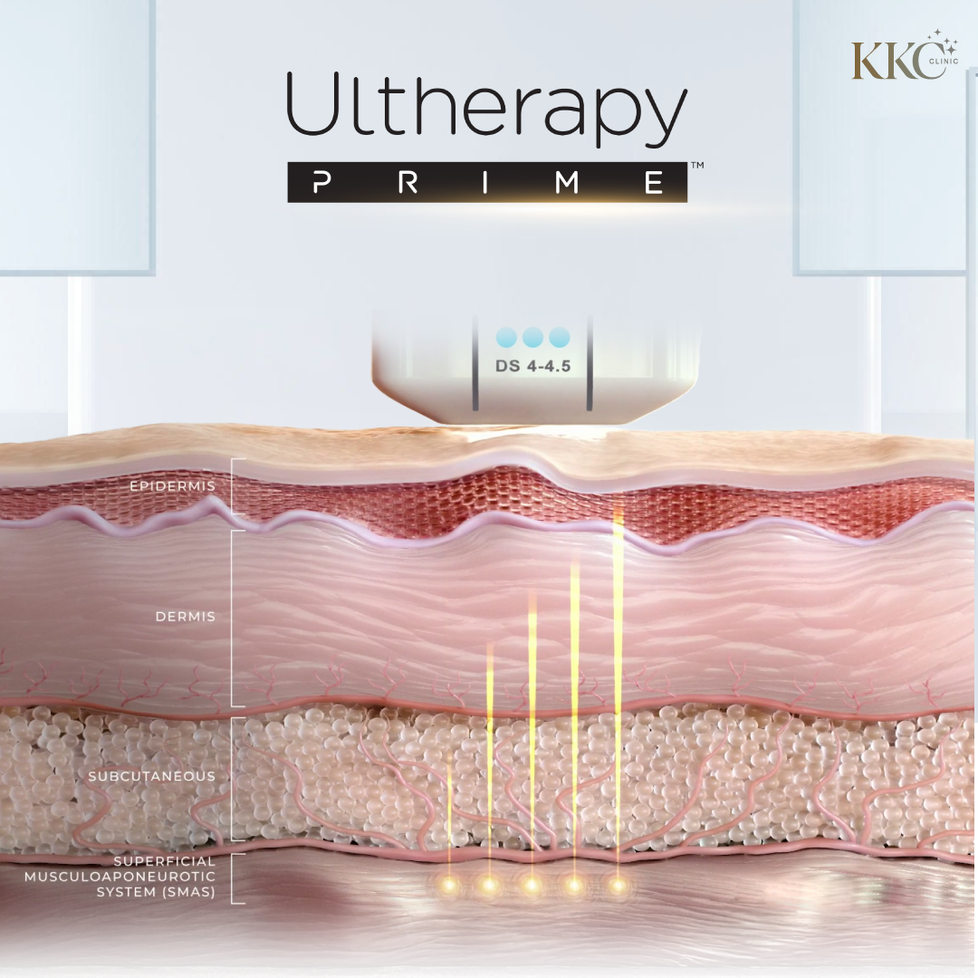 Ultherapy Prime in Bangkok | Non-Surgical Skin Lifting