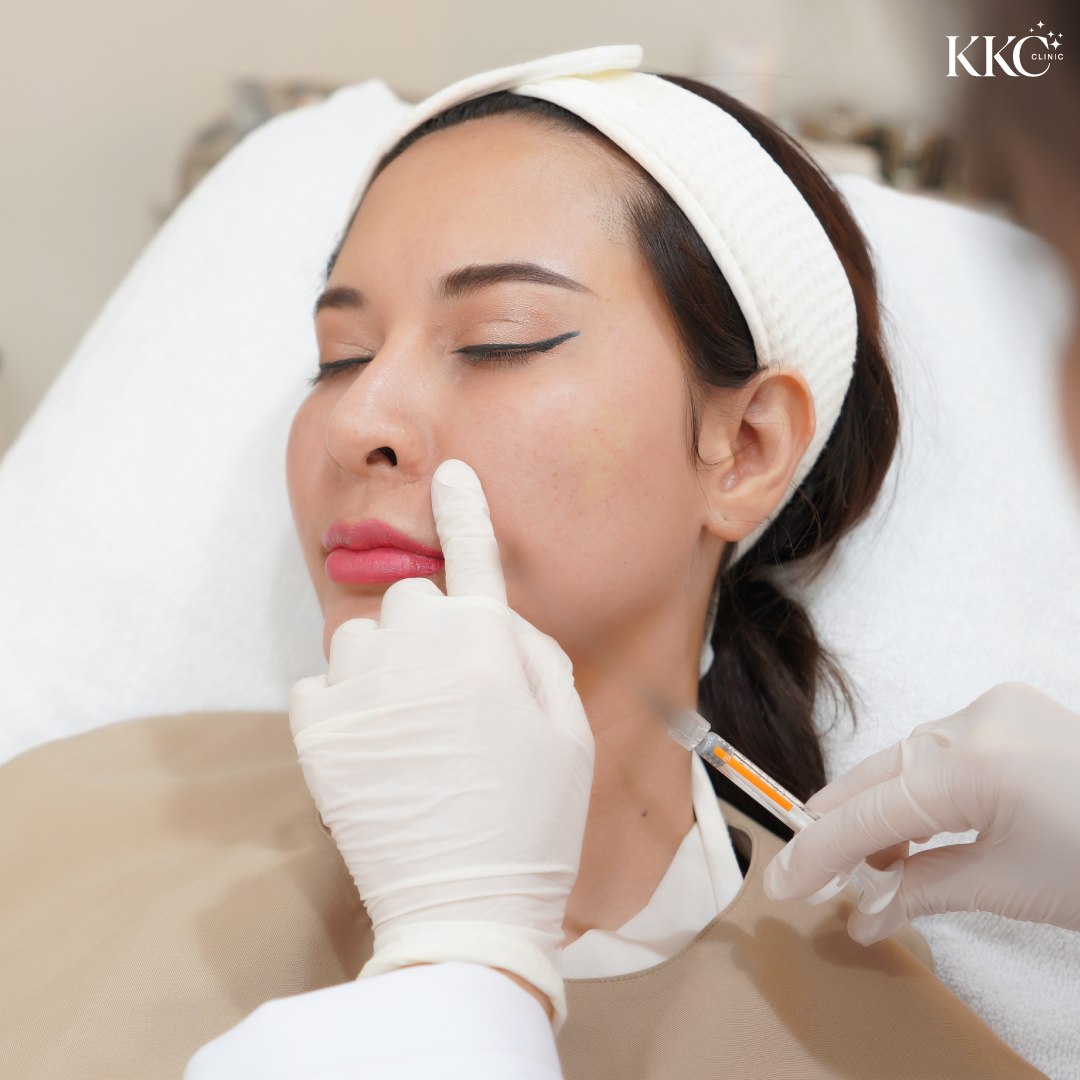 Smile Line Filler in Bangkok to Smooth Nasolabial Folds